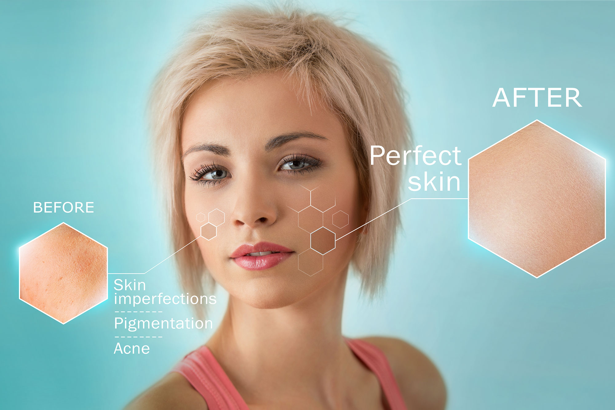 IPL - for Photo Rejuvenation - Skin Treatment in Cornwall - Senta Bodmin